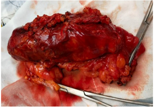 Migración completa de textiloma simulando tumor de colon