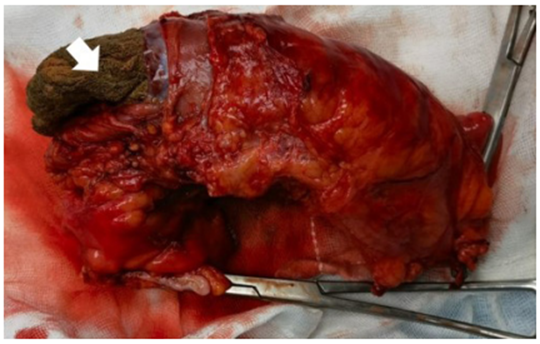Migración completa de textiloma simulando tumor de colon