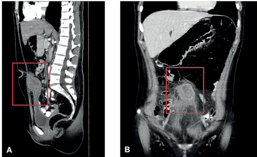 Persistencia de uraco en paciente joven. Reporte de caso