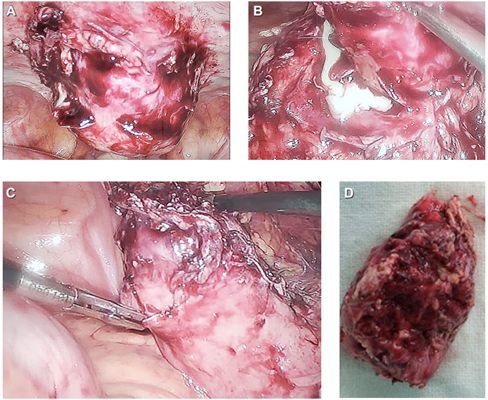 Persistencia de uraco en paciente joven. Reporte de caso