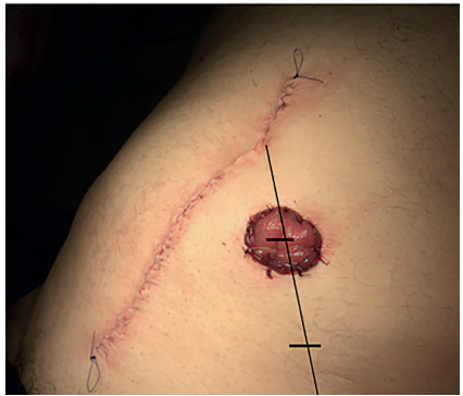 Estomas: complicaciones, manejo y prevención. Una revisión actual