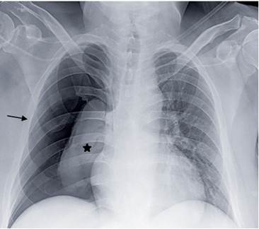 Edema pulmonar por reexpansión. Reporte de Caso