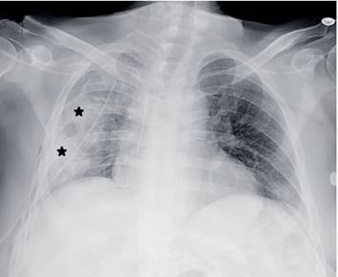 Radiografia De Edema Pulmonar Edema Pulmonar Por Reexpansión. Reporte
