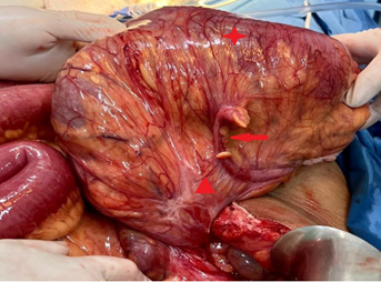 Vólvulo del ciego y dolicomegacolon andino. Reporte de caso