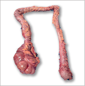 Vólvulo del ciego y dolicomegacolon andino. Reporte de caso