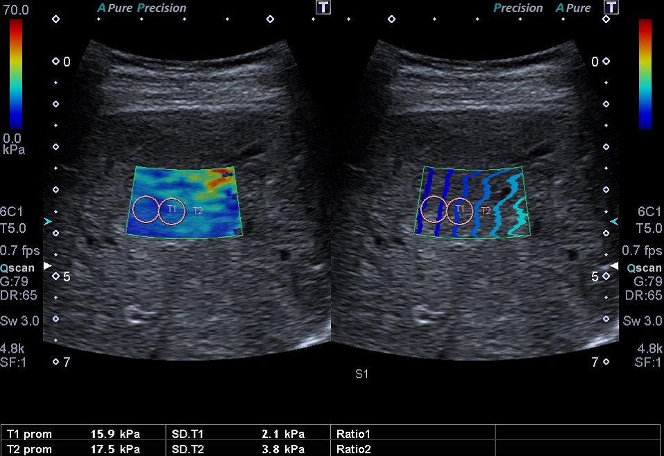 Hepatopatía tras la cirugía de Fontan