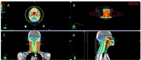 CÁNCER DE NASOFARINGE. TRATAMIENTO COMBINADO RADIOTERAPIA Y ...