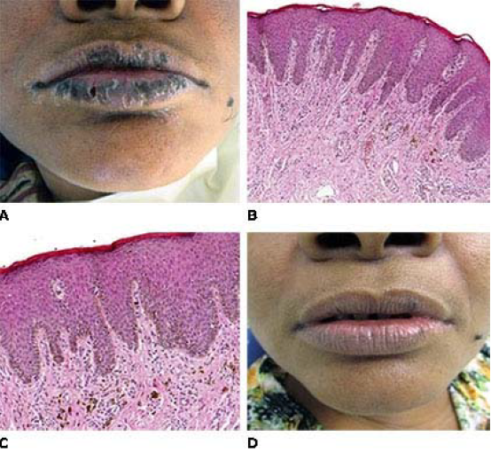 Queilite Esfoliativa Como Curar A Queilite Esfoliativa