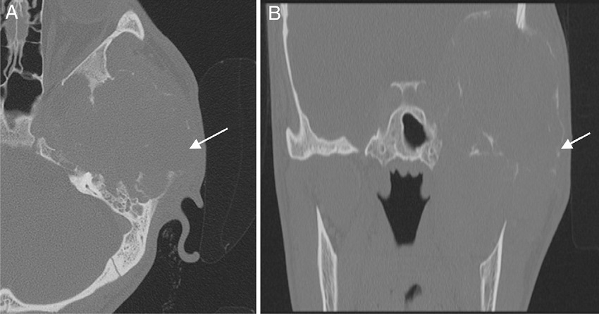 Aggressive osteoblastoma of the temporal bone: an unusual cause of ...
