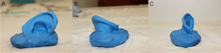 Pinna synthetic mold for otoplasty techniques application☆