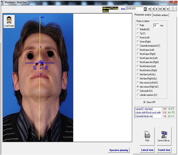 Outcomes of external septorhinoplasty in a Turkish male population☆