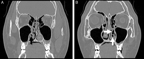 A case of bilateral inferior concha bullosa connecting to maxillary sinus☆