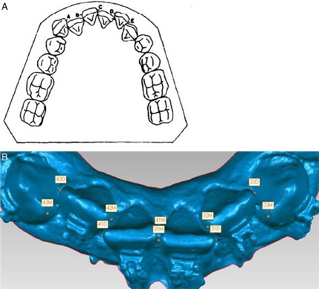 Side effects of intraoral devices for OSAS treatment☆