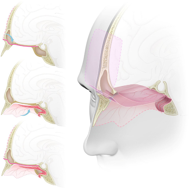 Endoscopic endonasal double flap technique for reconstruction of large anterior skull base ...