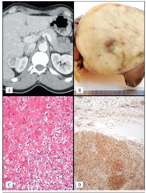 Solitary fibrous tumor of the kidney: a report of two cases