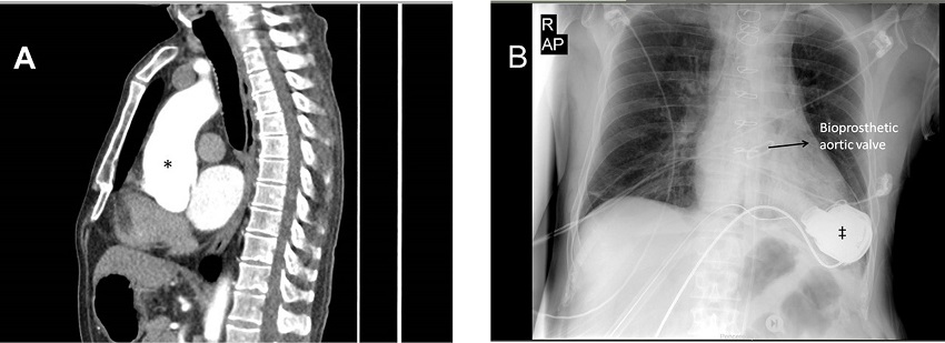 Left Ventricular Assist Device Implantation Combined with Bentall Procedure