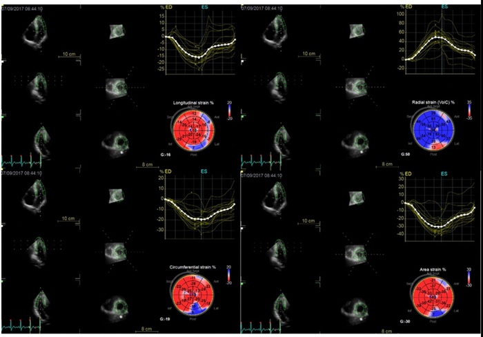 Evaluation of Left Ventricular Systolic Function in Patients with ...