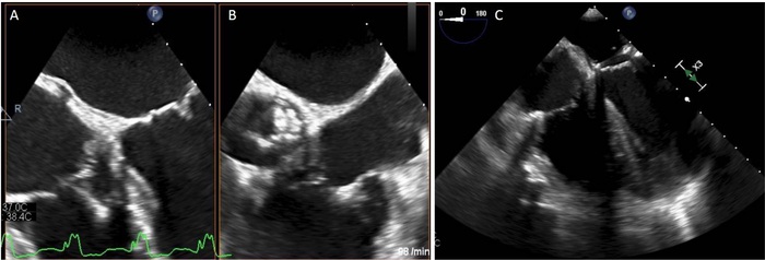 Laser Lead Extraction During Venoarterial ECMO support