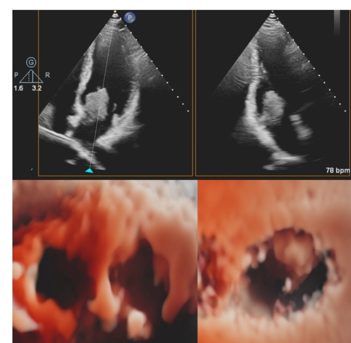 A Malignant Lymphoma Growing Inside a Cardiac Mixoma: A Case Report