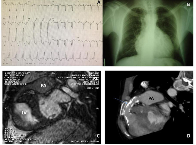 Congenitally Corrected Transposition of the Great Arteries in the Adult
