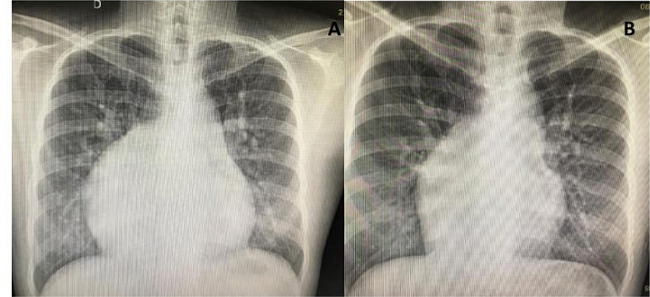 Congenitally Corrected Transposition of the Great Arteries in the Adult