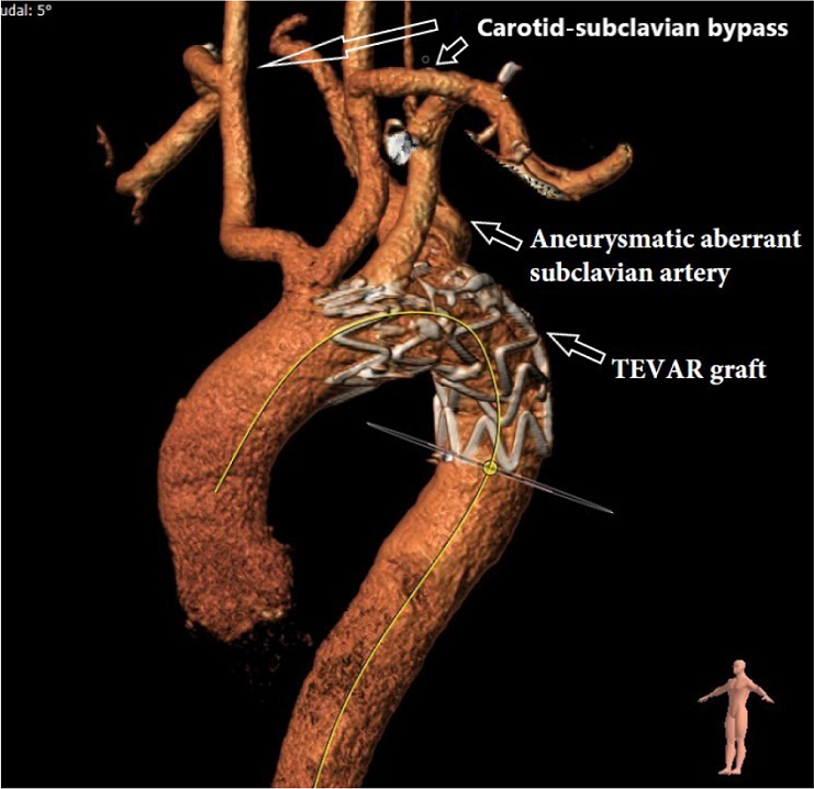 Three Different Strategies for Repair of Symptomatic or Aneurysmatic ...
