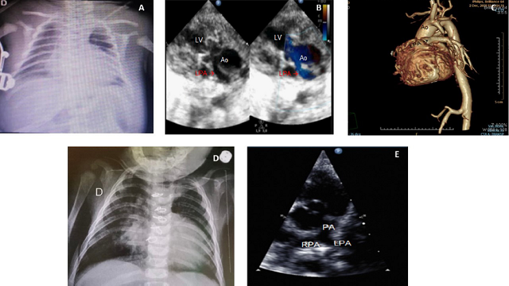 Abnormal Origin of the Pulmonary Artery from the Ascending Aorta in the ...