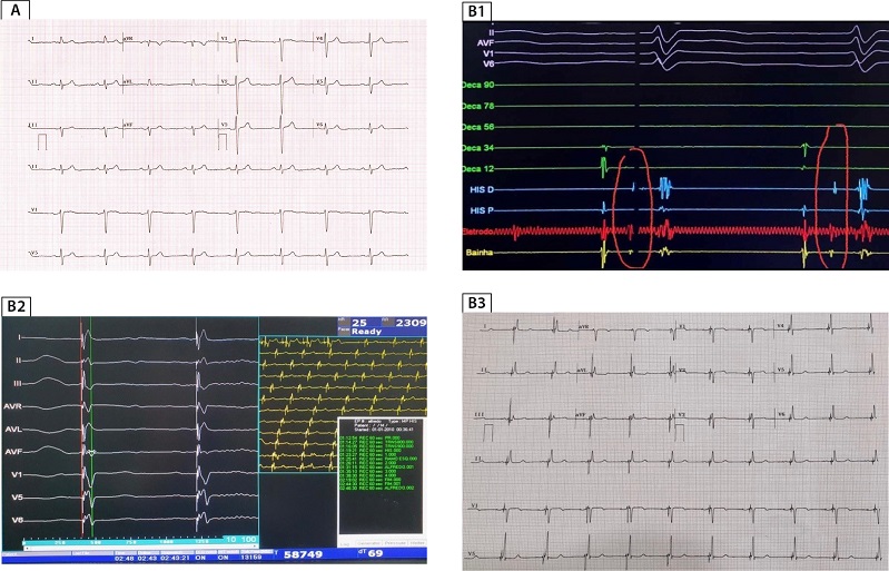 Cardiomyopathy Induced by Artificial Cardiac Pacing: To Whom, When, Why ...