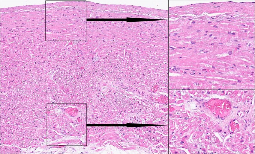 The Technology of Homogeneous Scar Tissue Creating as a Result of ...