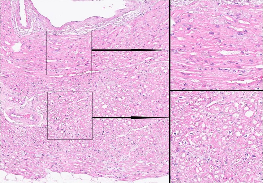 The Technology of Homogeneous Scar Tissue Creating as a Result of ...