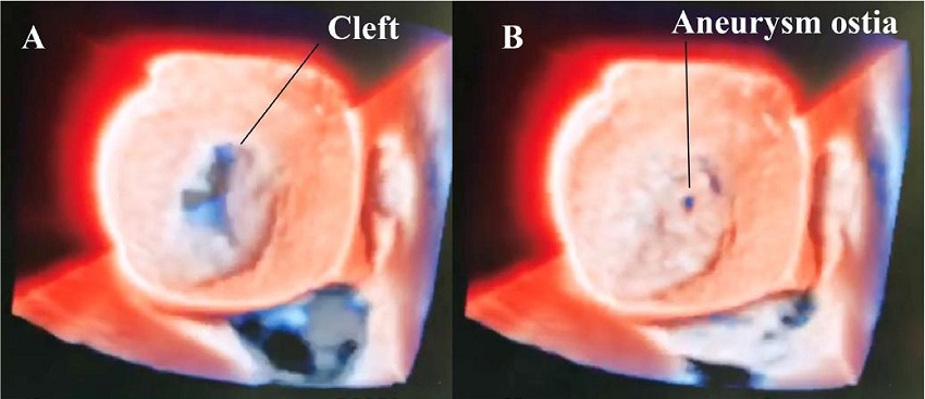Partial Atrioventricular Septal Defect with Left Atrioventricular Valve ...