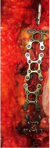 The Results of Rigid Titanium Plate Reinforcement and Only Conventional ...