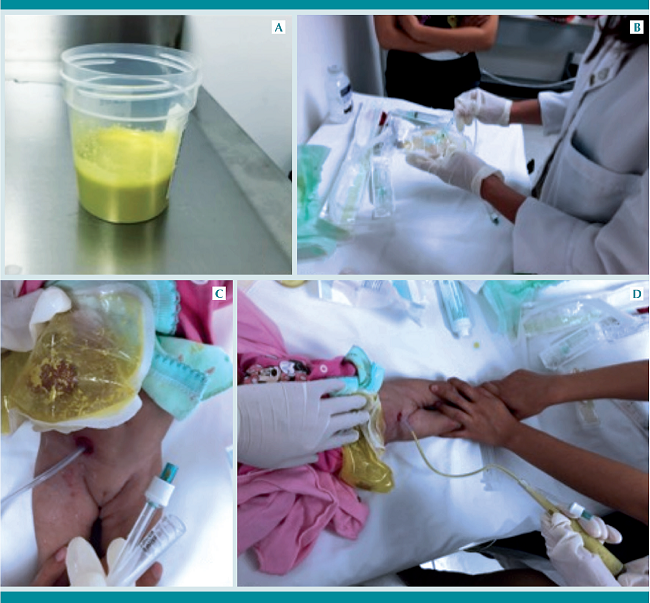 Realimentación por estoma distal en una serie de casos de niños con ...