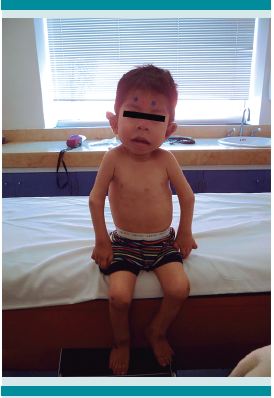 Síndrome de fibromatosis hialina: reporte de un caso y revisión ...