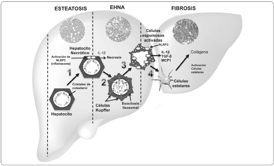 Alteraciones en la homeostasis del colesterol hepático y sus ...