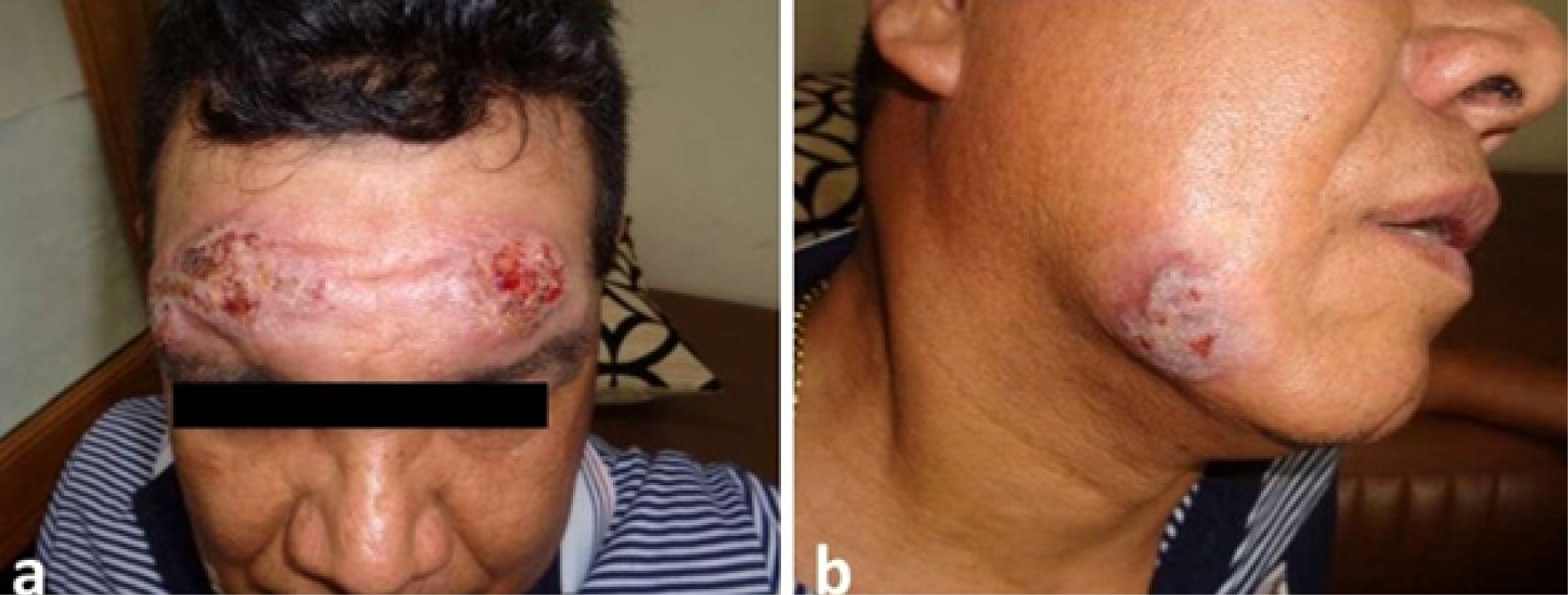 Tratamiento Combinado en Leishmaniasis Cutánea con Falla Terapéutica