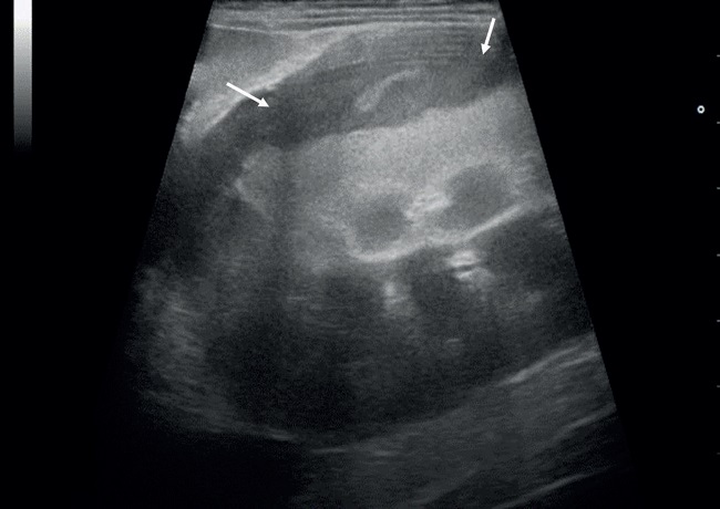 Renal capsulotomy associated with omentopexy for treatment of bilateral ...