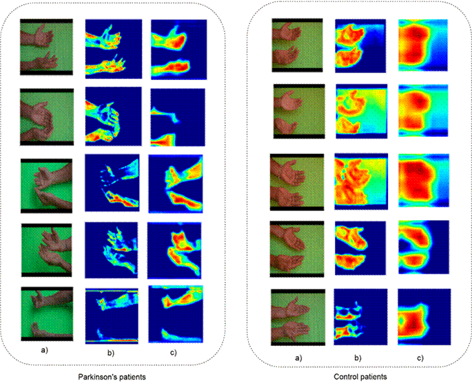 Hand Tremor Characterization from a Spatiotemporal Convolutional ...