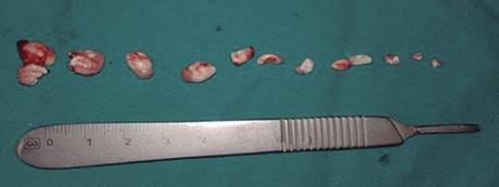 Complex-Compound Odontoma: A Rare Clinical Presentation