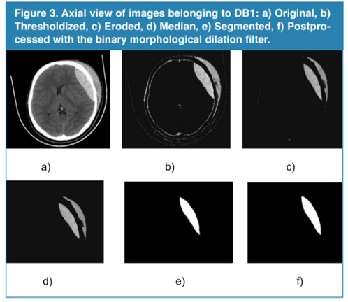Automatic segmentation of epidural hematomas using a computational technique based on ...