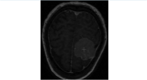 Automatic segmentation of a meningioma using a computational technique in magnetic resonance imaging