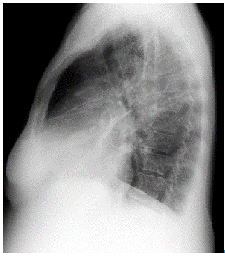Lingular Pneumonia