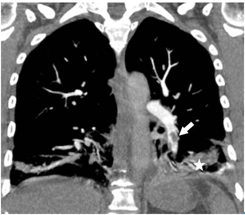 INFECTED PULMONARY INFARCTION CASE REPORT