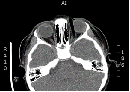 PEDIATRIC OCULAR TRAUMA: INTRAORBITAL FOREIGN BODY. CASE REPORT