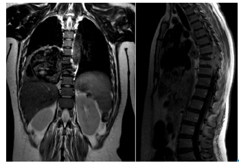 GIANT CELL TUMOR OF THE DORSAL VERTEBRAE. CASE REPORT