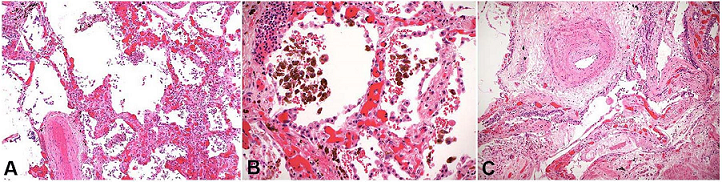Pulmonary capillary hemangiomatosis: a lesson learned