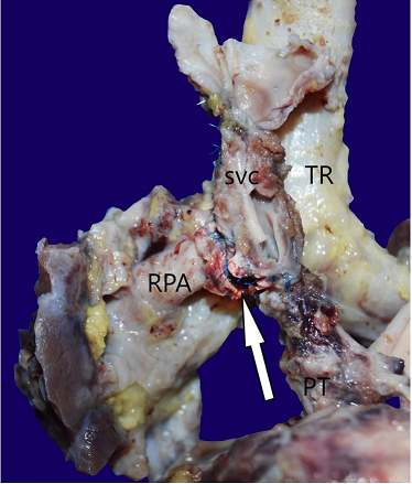 Superior vena cava obstruction after the Glenn procedure