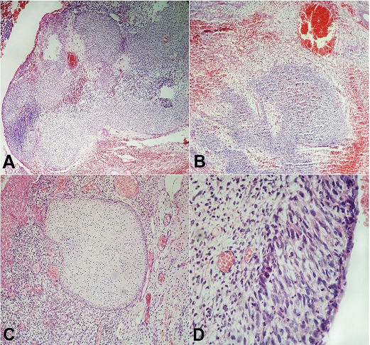 Uterine cavity embryonal rhabdomyosarcoma