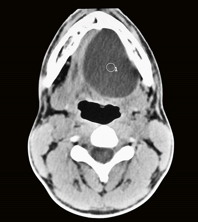 Diagnosis, management, and follow-up of extensive dermoid cyst of the ...