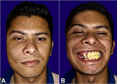 Fibrous Dysplasia treated with virtual planning – report of two cases